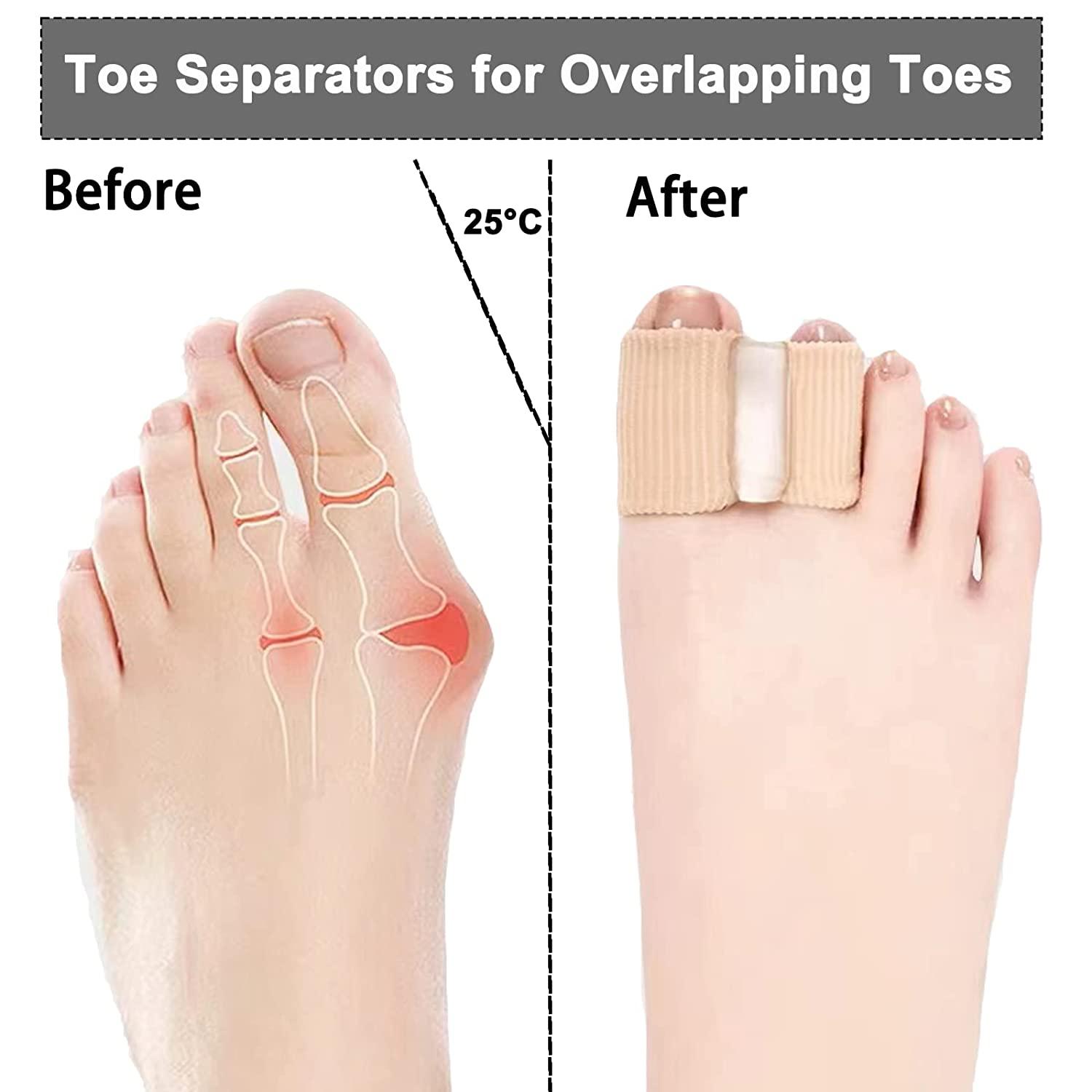 12 Pack Toe Spacers for Women and Men - Overlapping Toes, Bunions ...