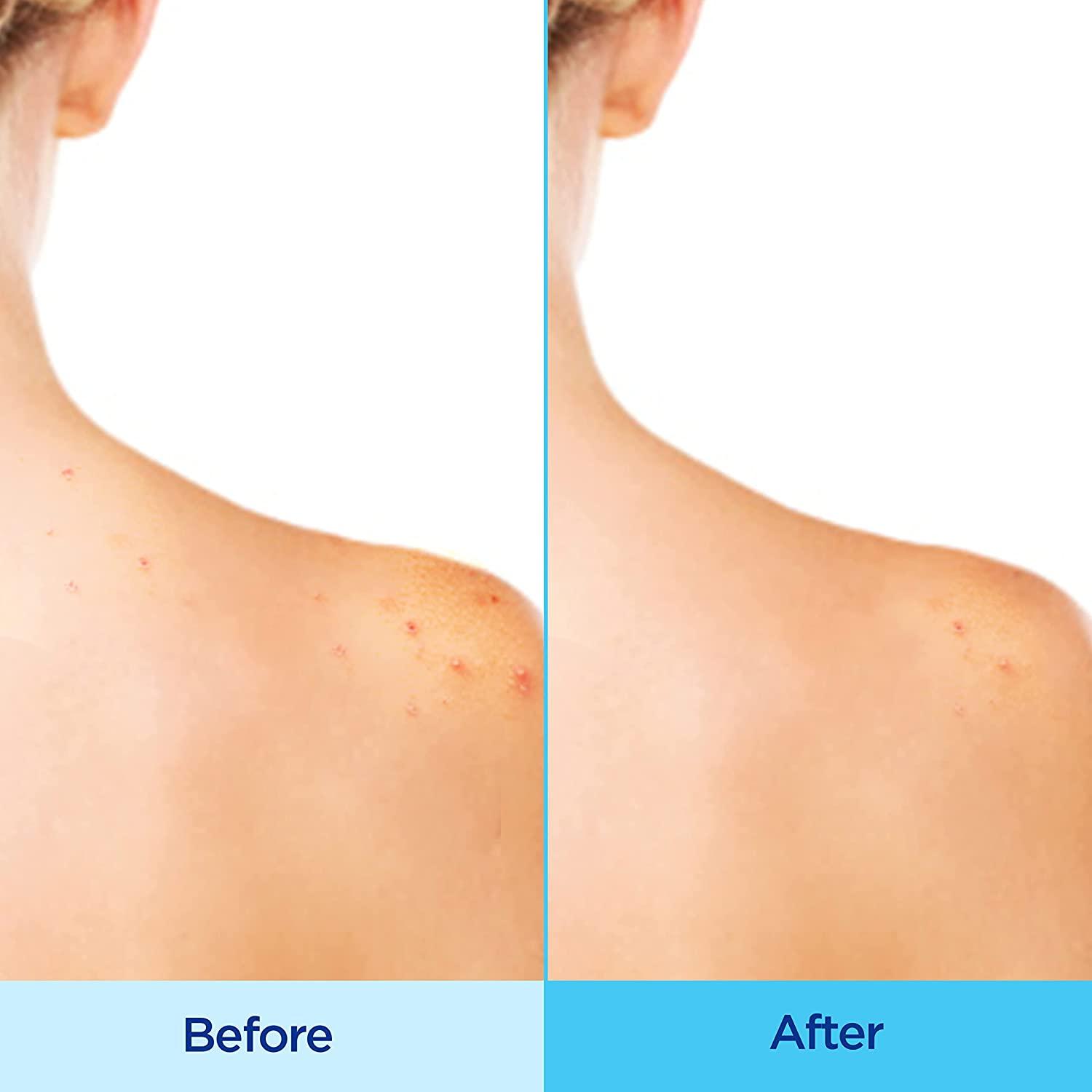 Differin Acne Body Spray, Acne Treatment with Salicylic Acid by the ...