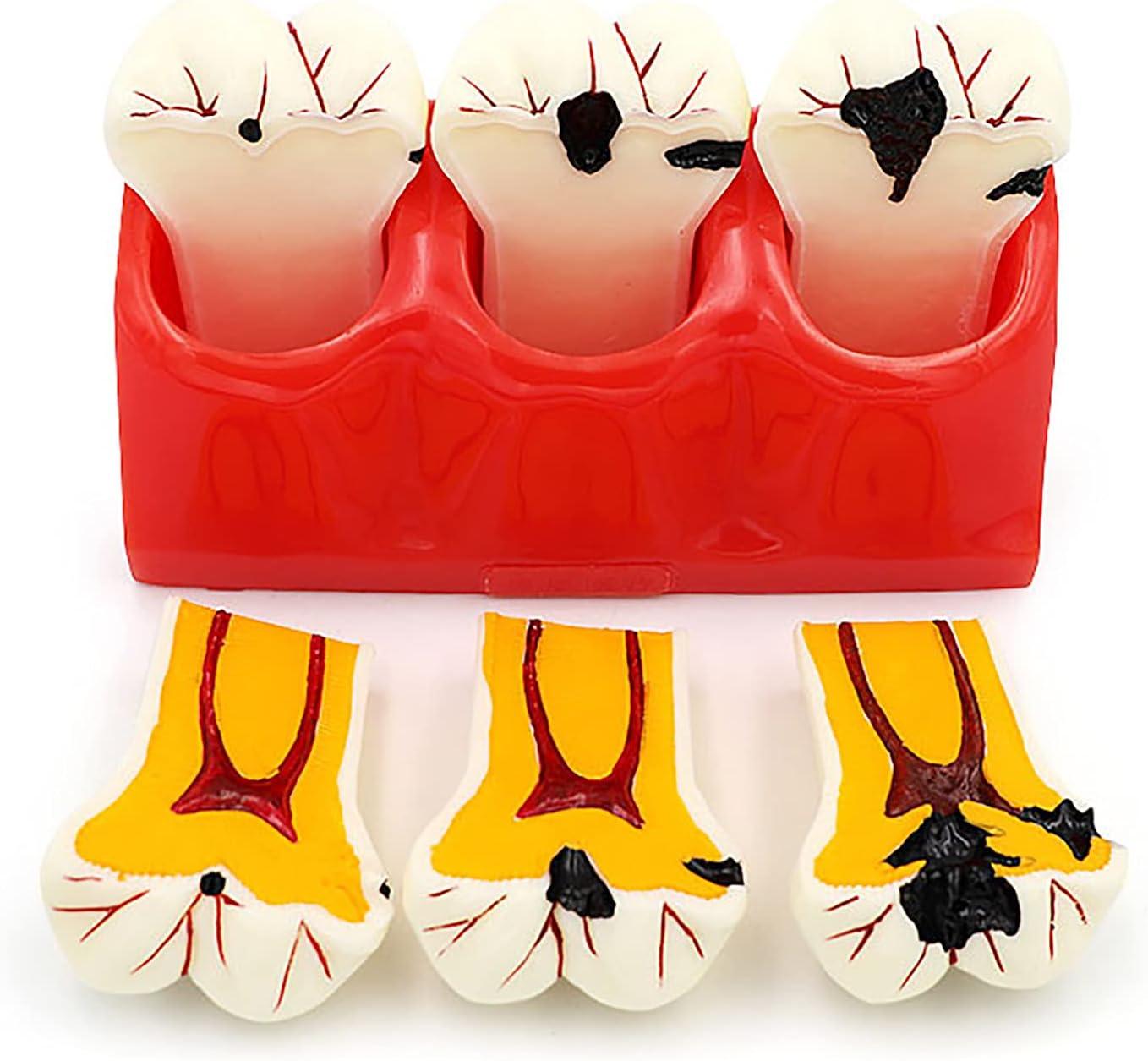Buy Samnuerly 4-Fold Dental Teeth Caries Model - Removable Tooth ...