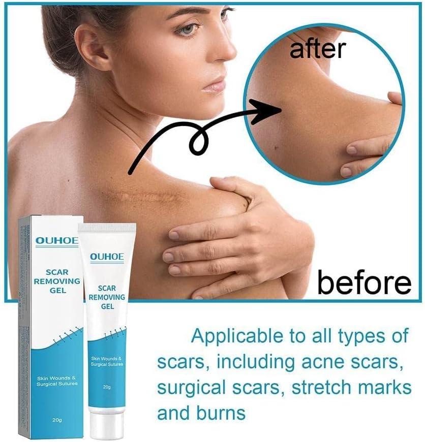 Waitlover Scar Removal Cream Gel - 20g | Repairs Pock Marks, Burns ...