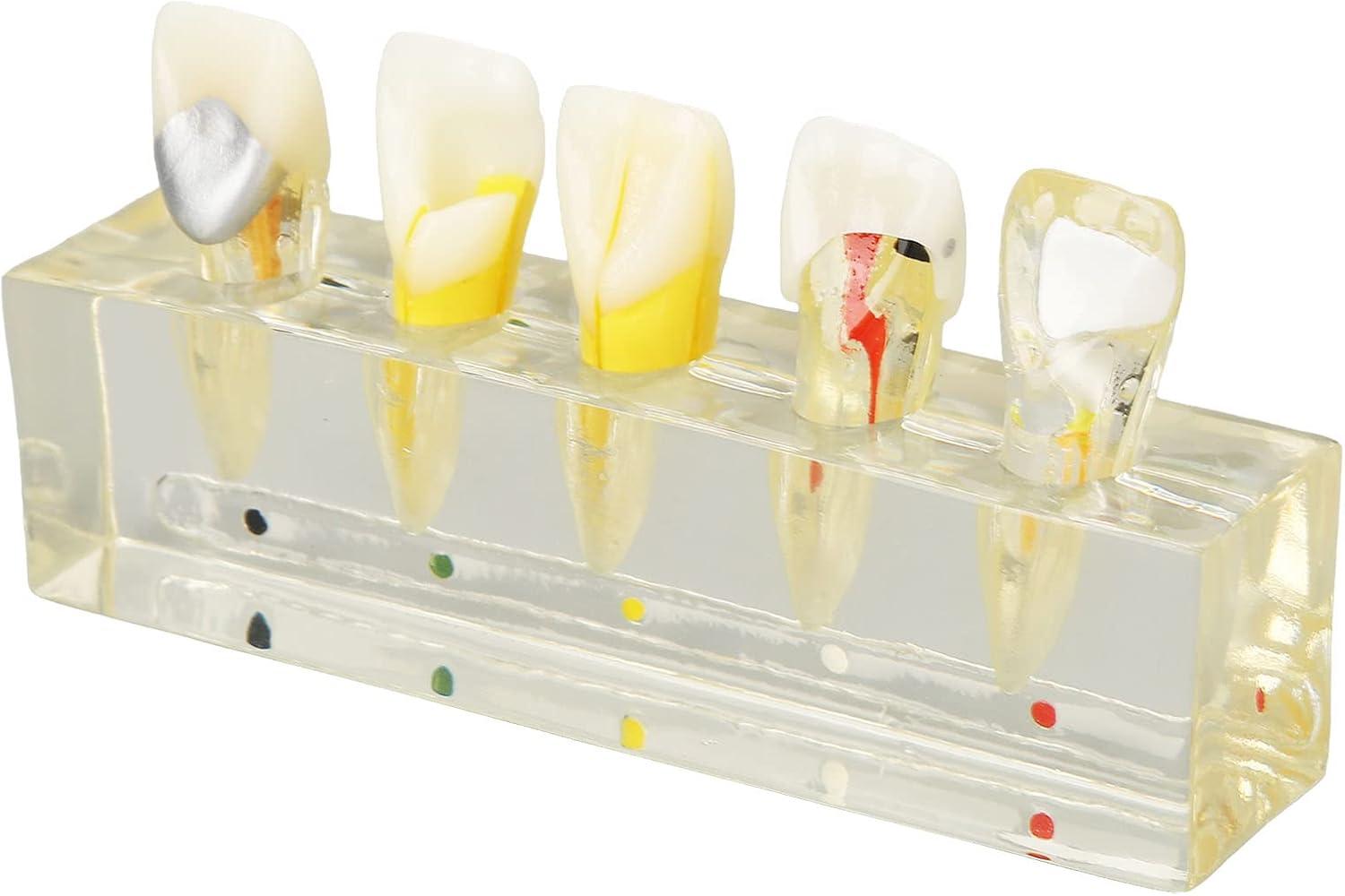 Endodontic Model - Stable Portable Dental Pulp Model for Practice ...