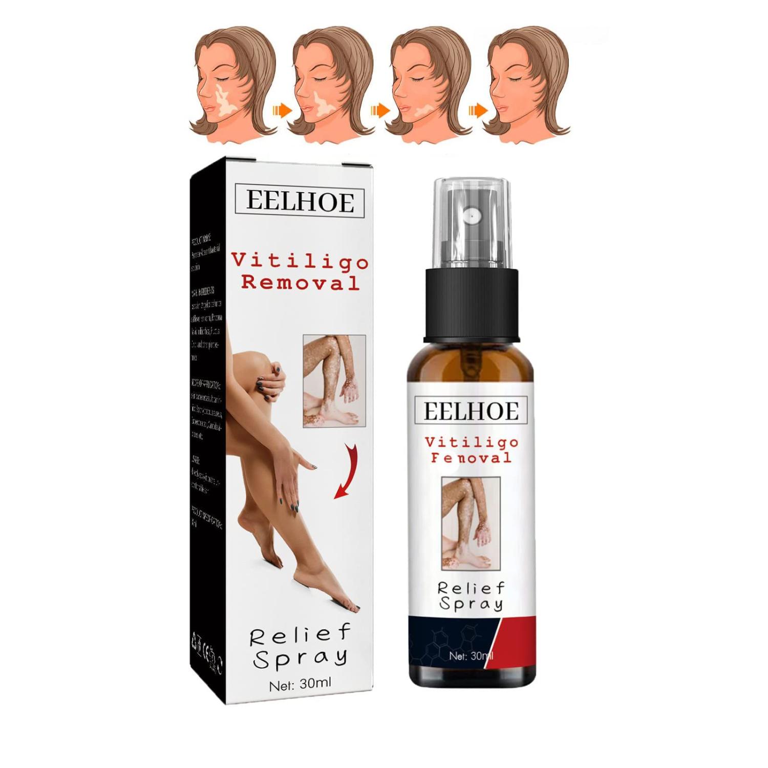 Vitiligo Removal Spray - Improve Skin Pigmentation & Remove White Spots ...