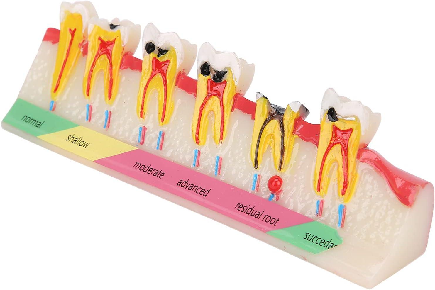 Caries Development Model - Portable Decayed Teeth Model for Dental ...