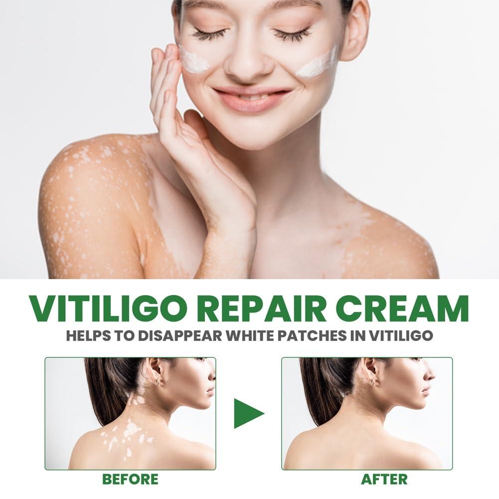 Finxenow TreatVitiligo Soothing Cream - Natural Care to Improve ...