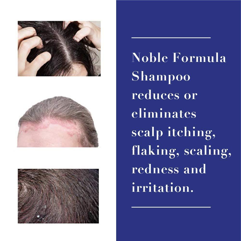 Noble Formula 2% Pyrithione Zinc Shampoo - 8 oz (Pack of 1) | Buy Now ...