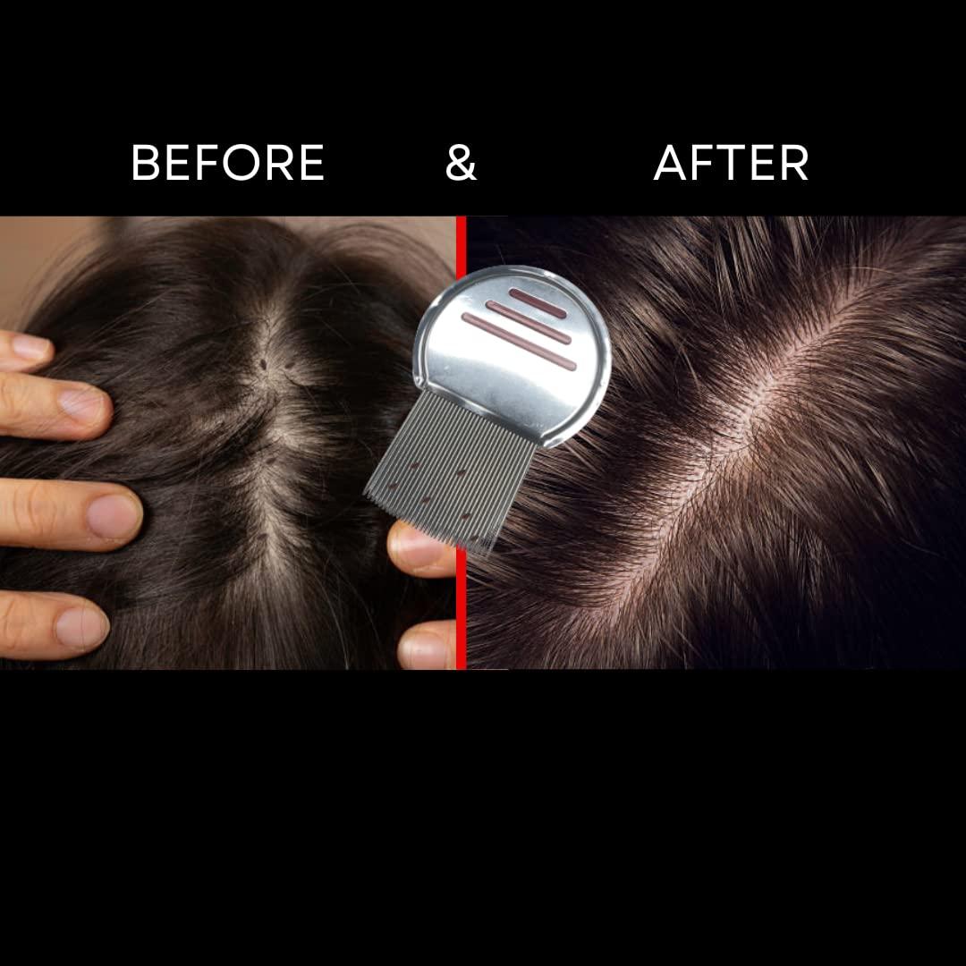 Terminator Lice Comb - Fast and Effective Lice Removal Tool (1 Pack ...