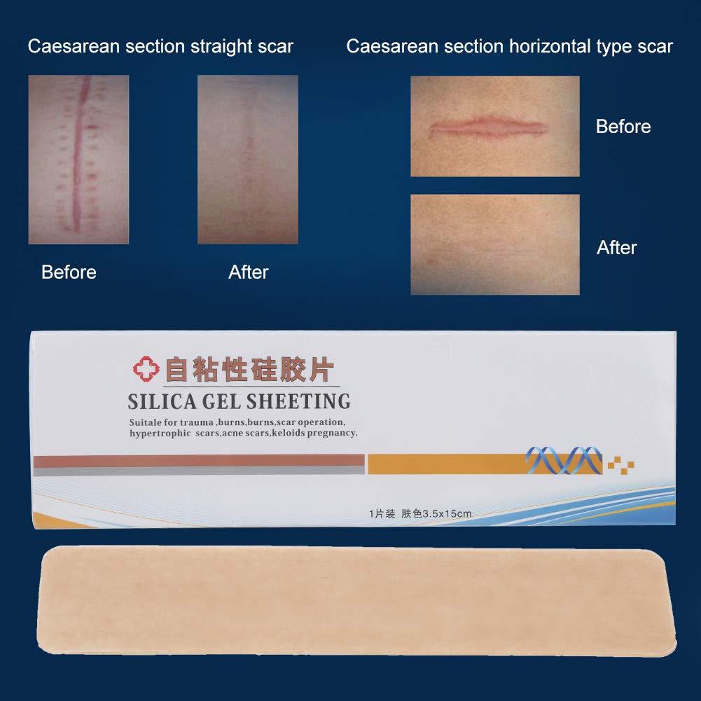 Silicone Scar Sheet for Professional Scar Removal - Wound Marks and ...