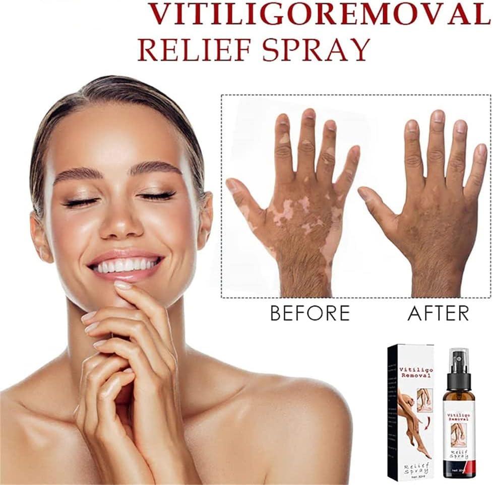 Camic Vitiligoremoval Relief Spray Kolmax Vitiligo Relief Spray ...
