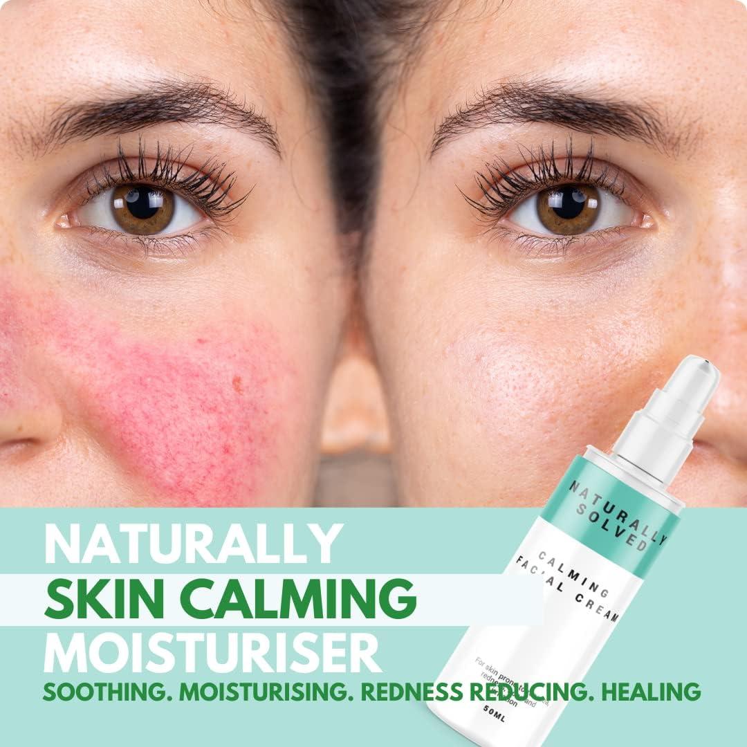 Calming Facial Moisturising Cream. For Rosacea Facial Redness Acne Dry ...
