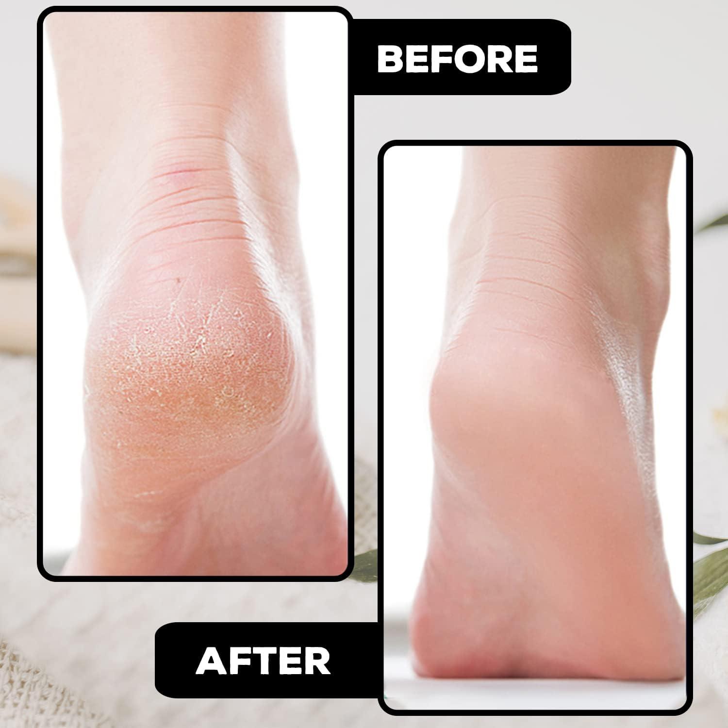 Pedicure Foot File for Hard Skin Removal | Metal Surface Dead Skin ...