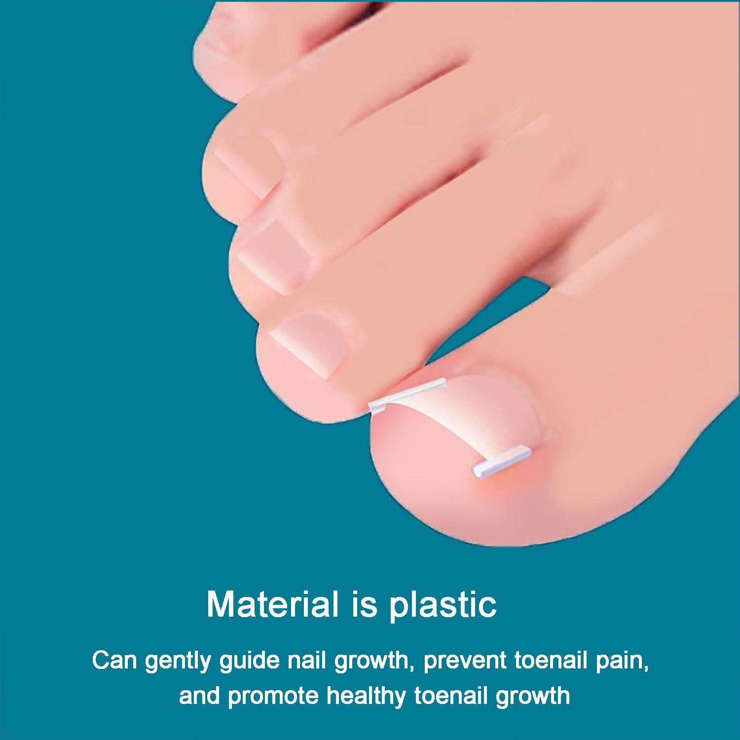 Ingrown Toenail Correction Set - 42 C-Shaped Fill Padding | Simple Tool ...