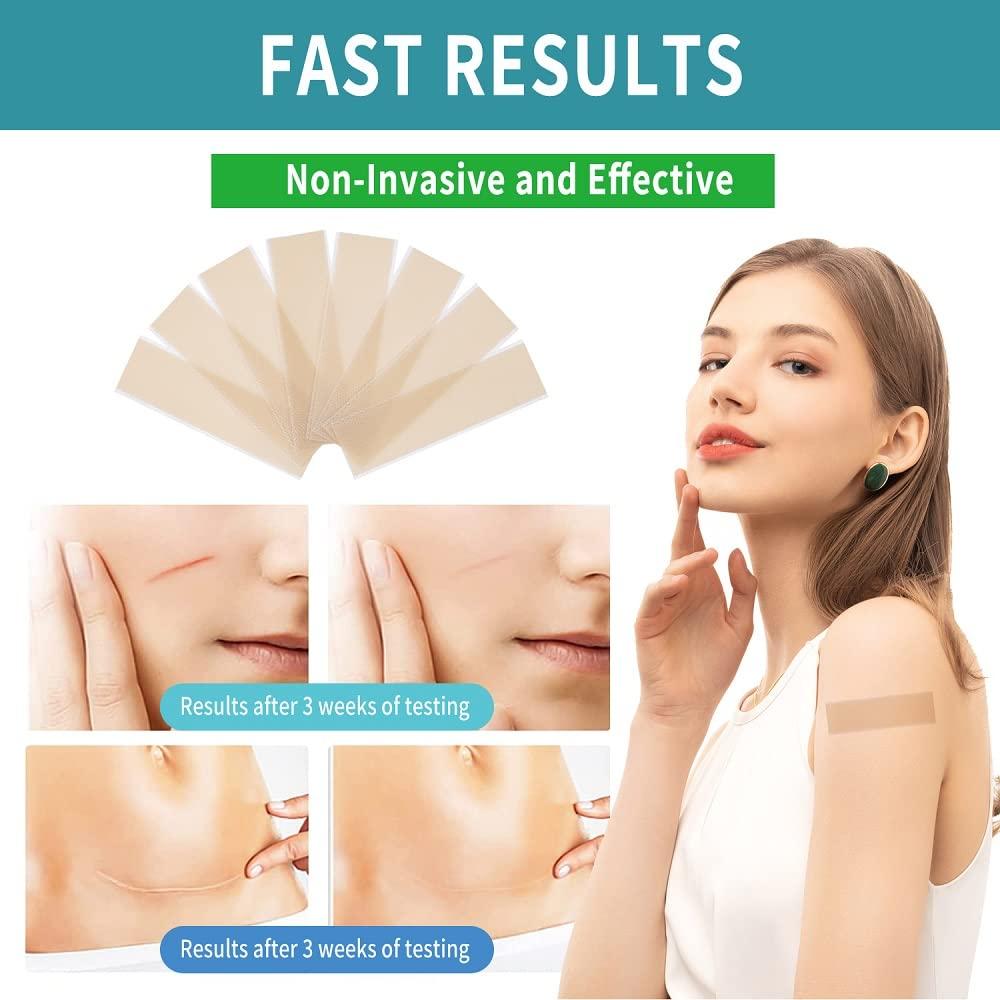 Sialicess Reusable Silicone Scar Strips for Keloid & Hypertrophic Scars ...