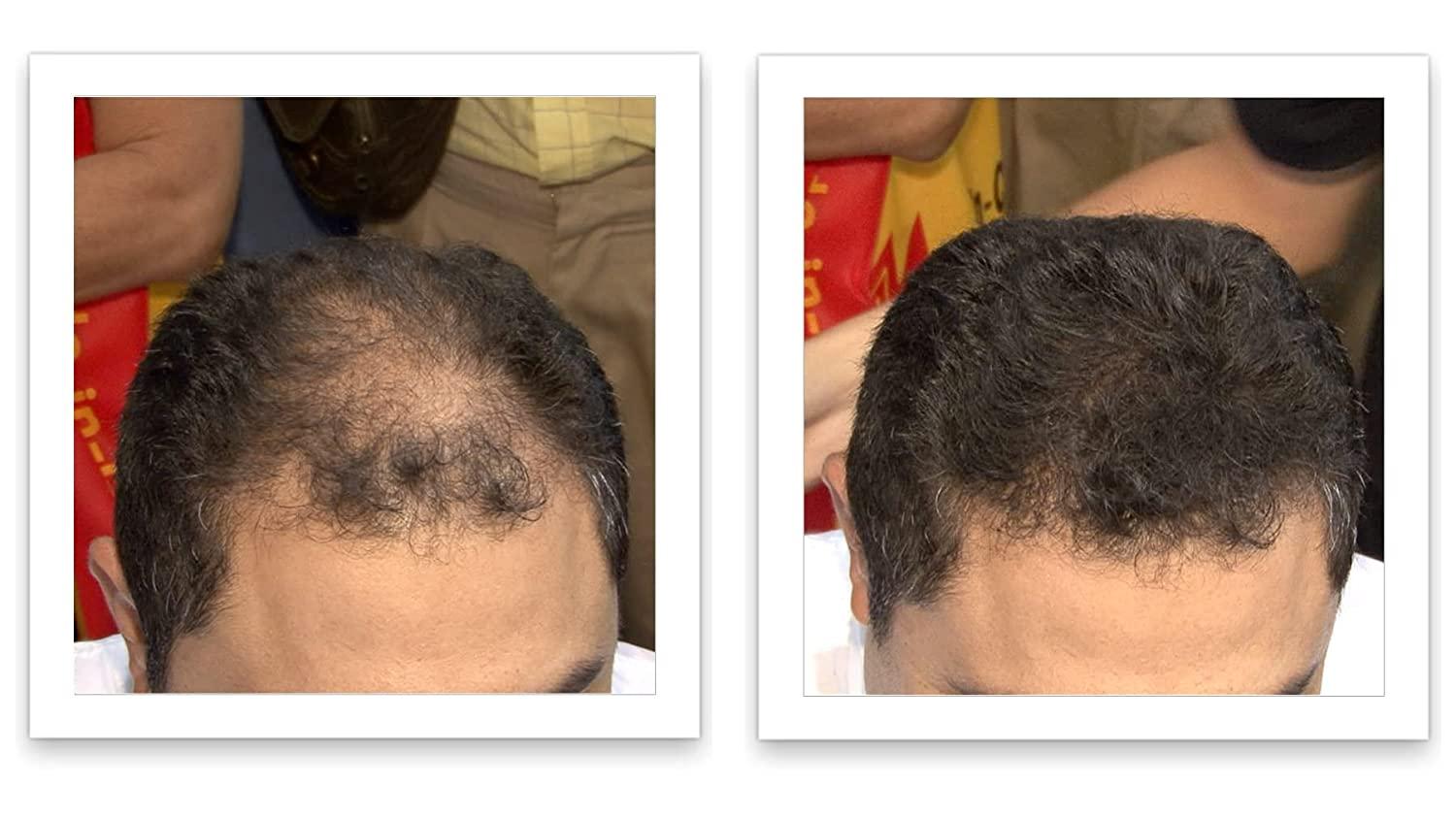 Dark Brown Hair Loss Concealer Trial Size - Cover Bald Spots Instantly ...