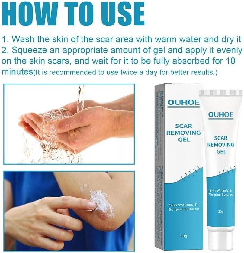 Waitlover Scar Removal Cream Gel - 20g | Repairs Pock Marks, Burns ...