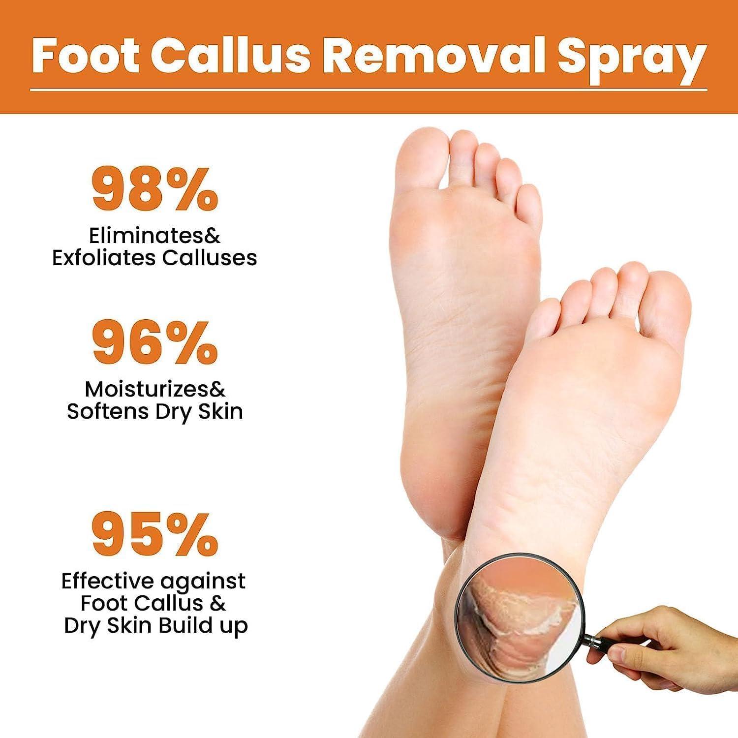 2PC Foot Callus Removal Spray - Instant Dead Skin & Callus Peeling with ...