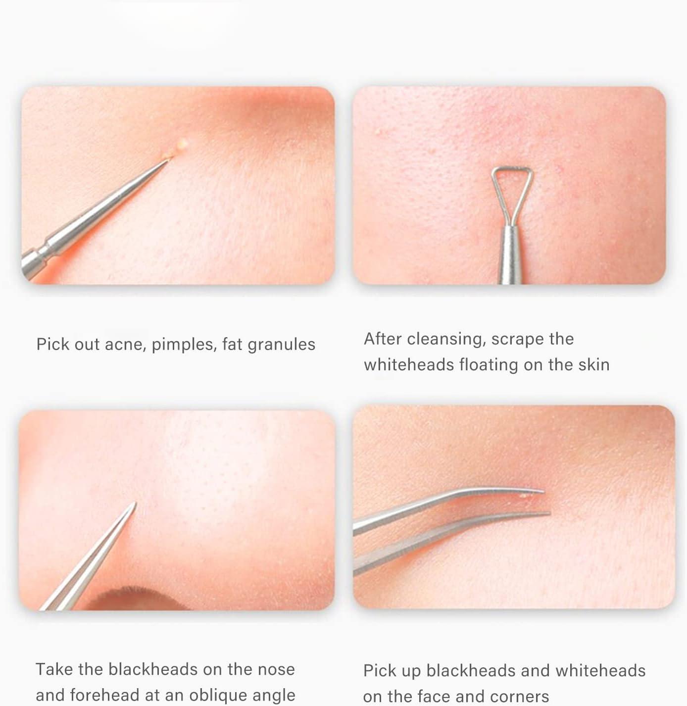 Blackhead Removal Tool Kit - Professional Stainless Steel Extractor for ...