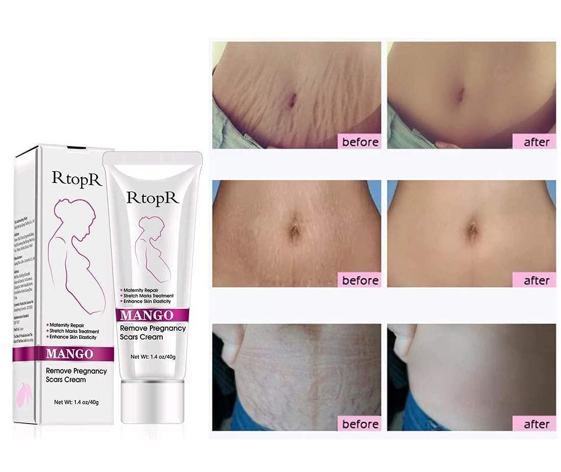 RtopR Mango Stretch Marks & Scar Cream - Pregnancy Safe Moisturizer ...