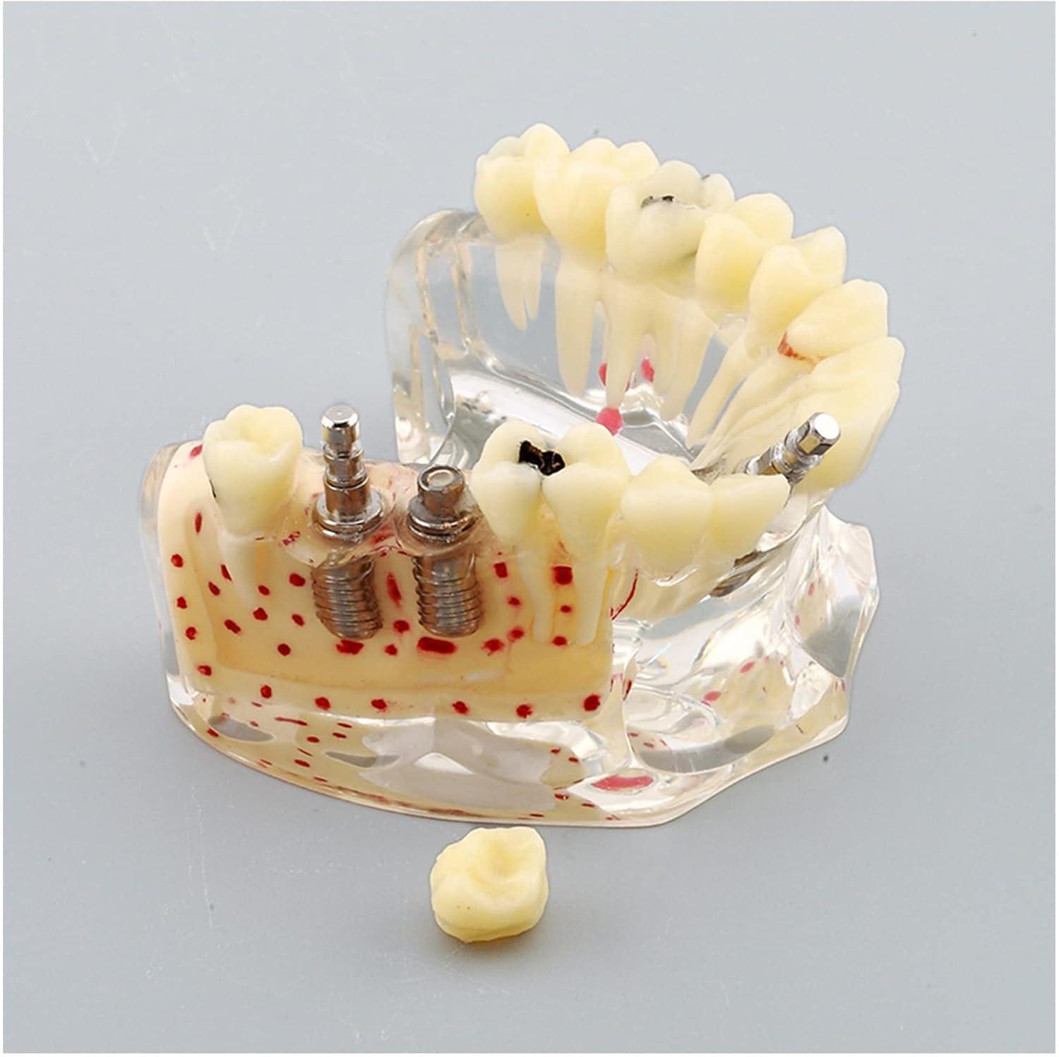 Dental Upper Implant Model for Overdenture Restoration | Transparent ...
