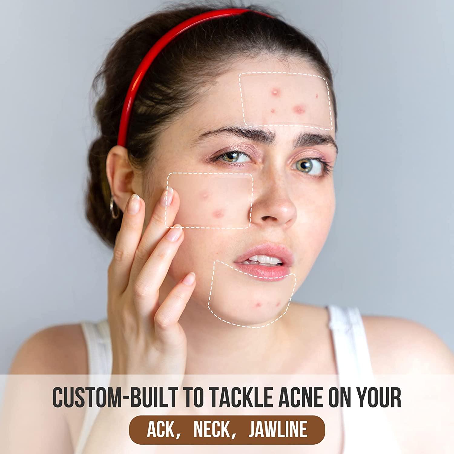 AUSLKA Large Blemish Pimple Patches (20 Strips) - Hydrocolloid Spot ...