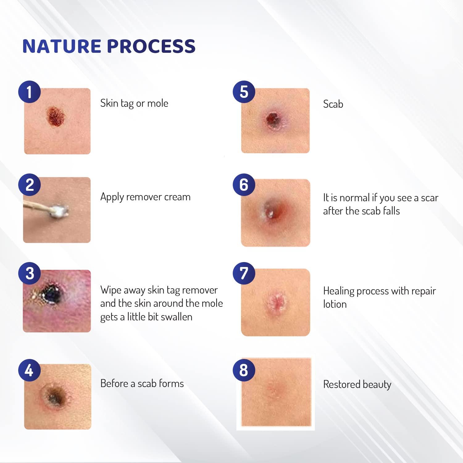 Mole Removal & Skin Tag Repair Gel Set - Remove Effectively at Home ...