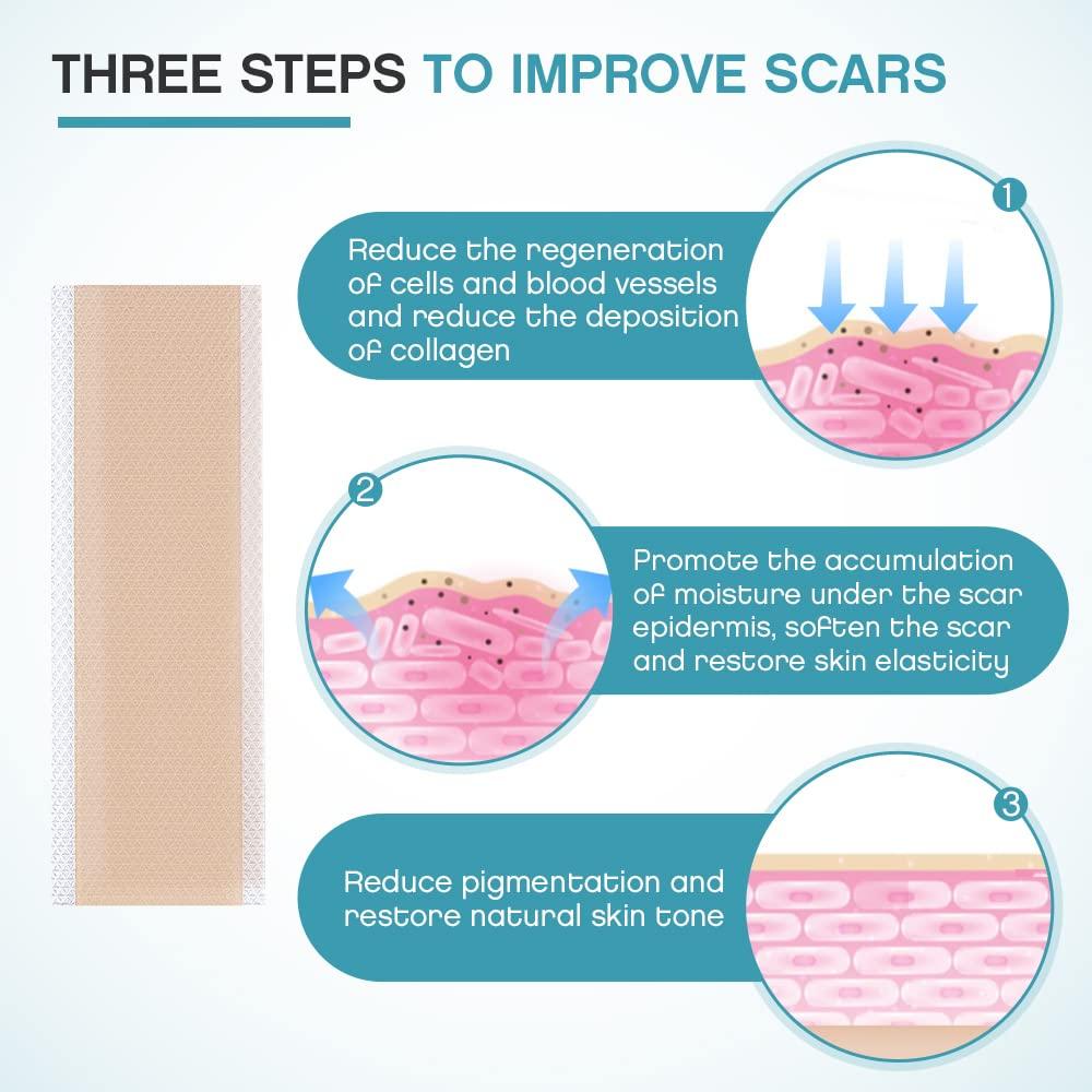 Silicone Scar Strips 1.6''x6'' - 4 pcs Multi-Use Scar Removal Cream (2 ...