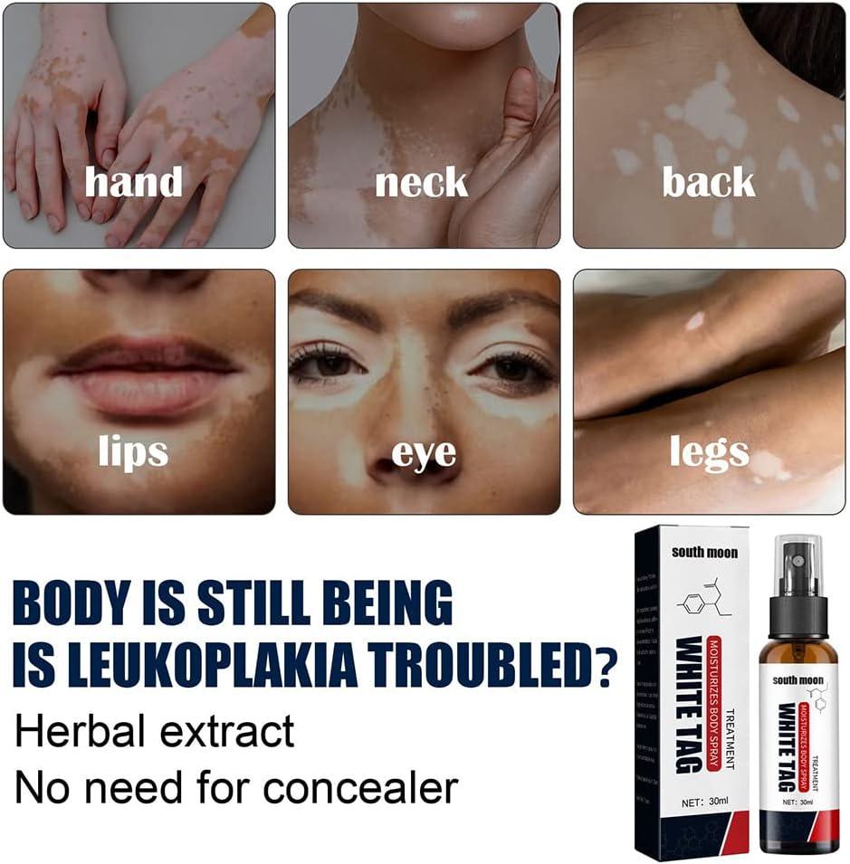 Kolmax Alkyne Psoriasis and Vitiligo Relief Spray - Reduces White Spots ...