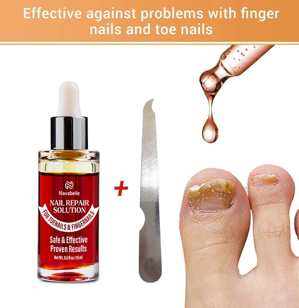 Extra Strength Toe Nail Fungus Treatment - Nail Repair Solution for ...