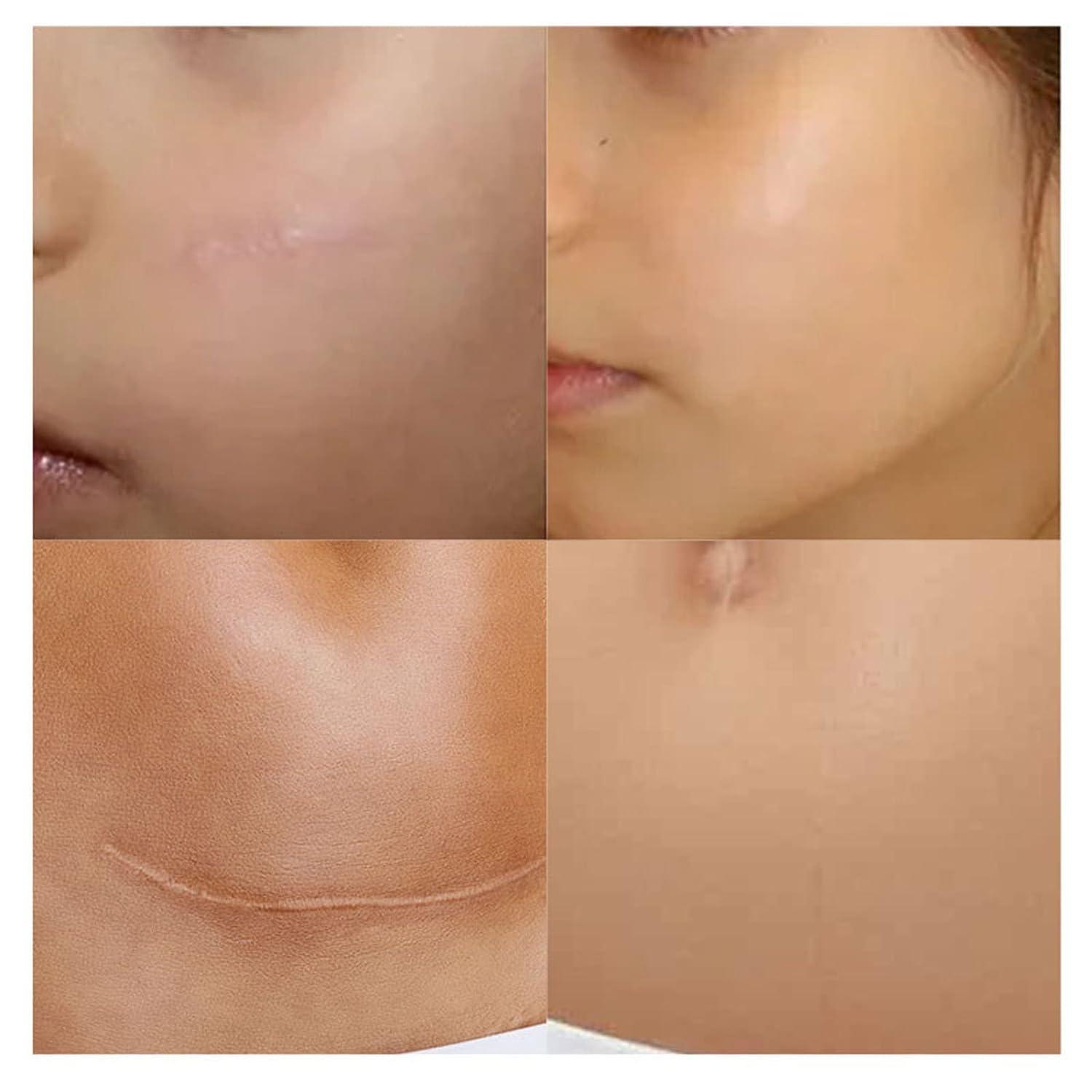 Scald & Wound Scar Removal Cream - Tummy Scars Care, 15pcs