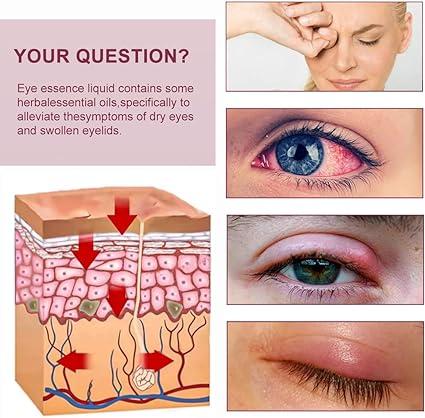 Eye Stye Remover for Fast Relief - Gentle Treatment for Styes Chalazion ...