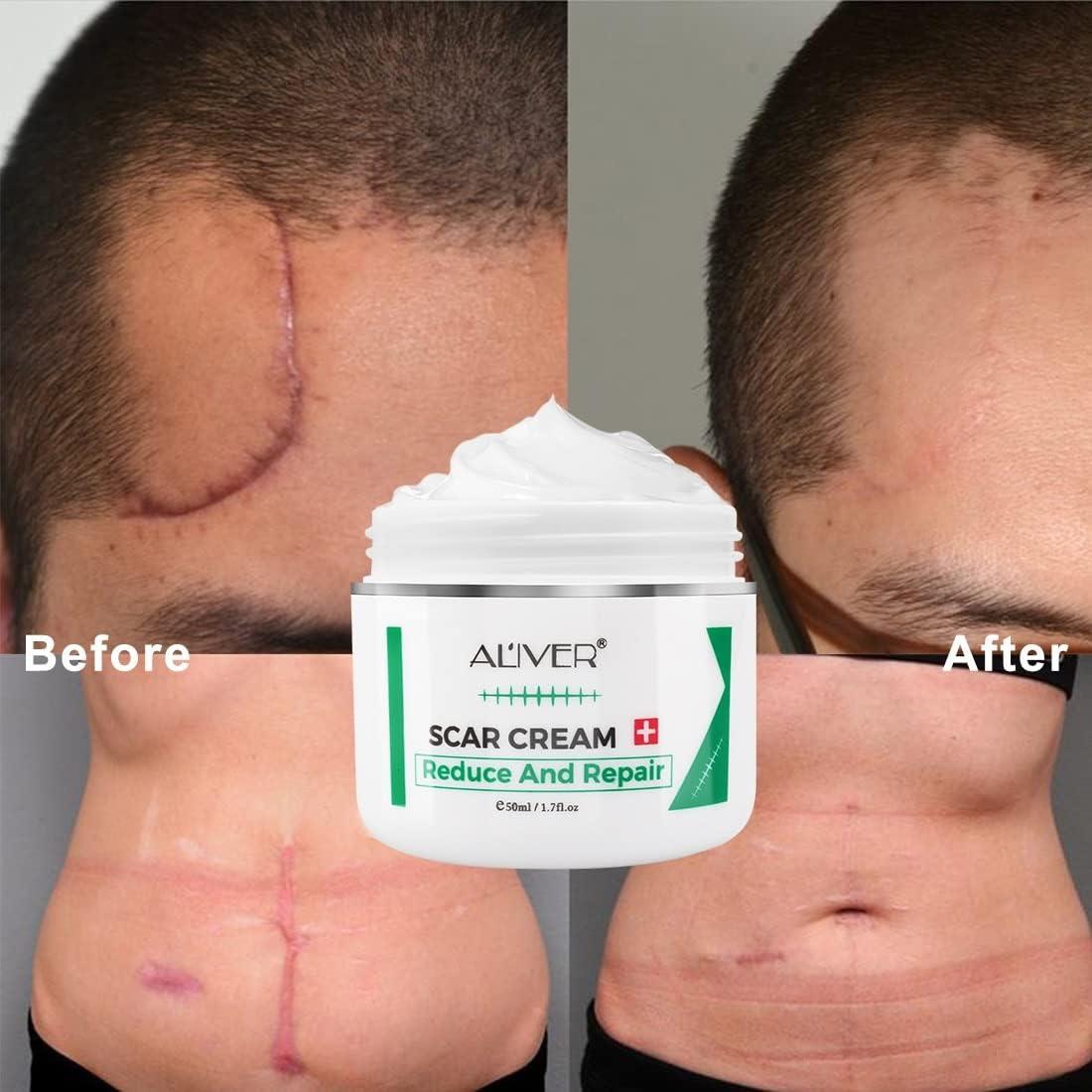 Scar Repair Cream | Acne Scar Removal & Pigmentation Corrector ...