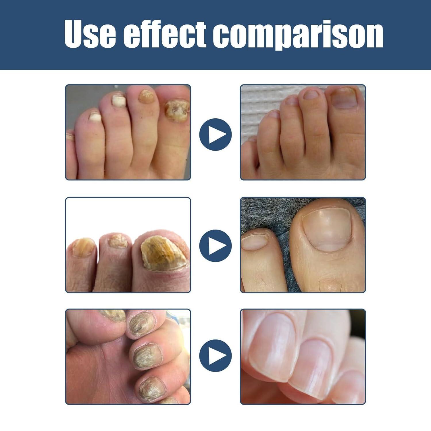 3 Pcs Furzero Athletes Foot & Nail Treatment Spray - Medical Grade Anti ...