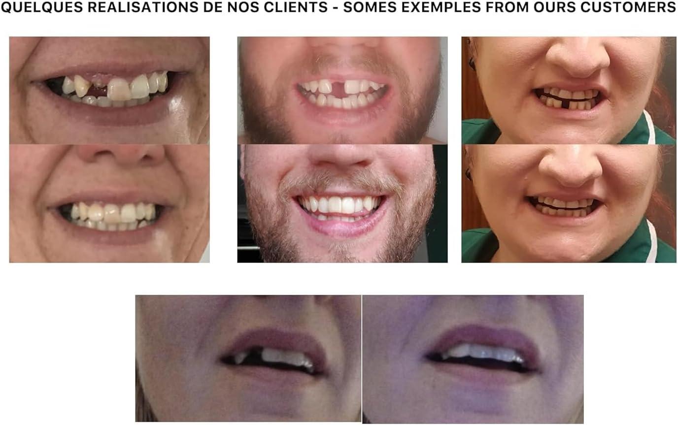 CREADENT Temporary Cosmetic Tooth Replacement Kit - Easy DIY Solution ...