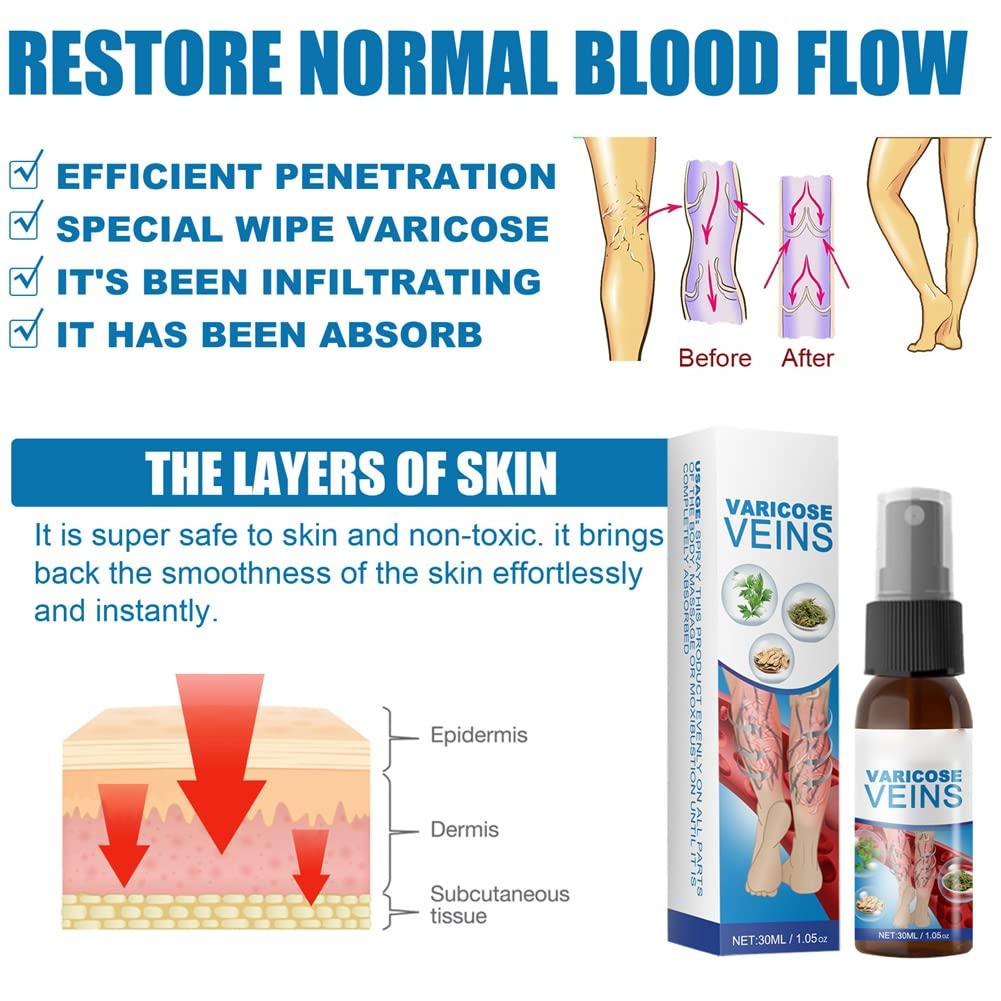 Varicose Veins Cream - Lichengtai Miracle Spray for Varicose & Spider ...
