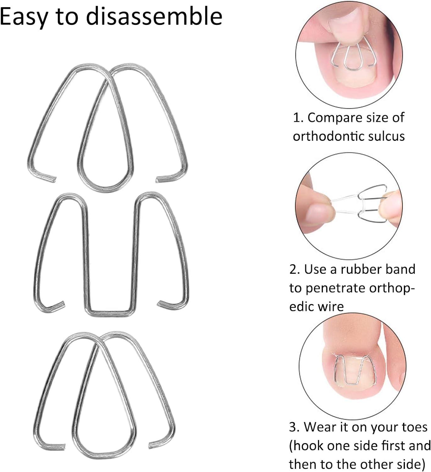 Ingrown Nail Corrector Relieve Pressure Ingrown Toenail Wire Fixer ...