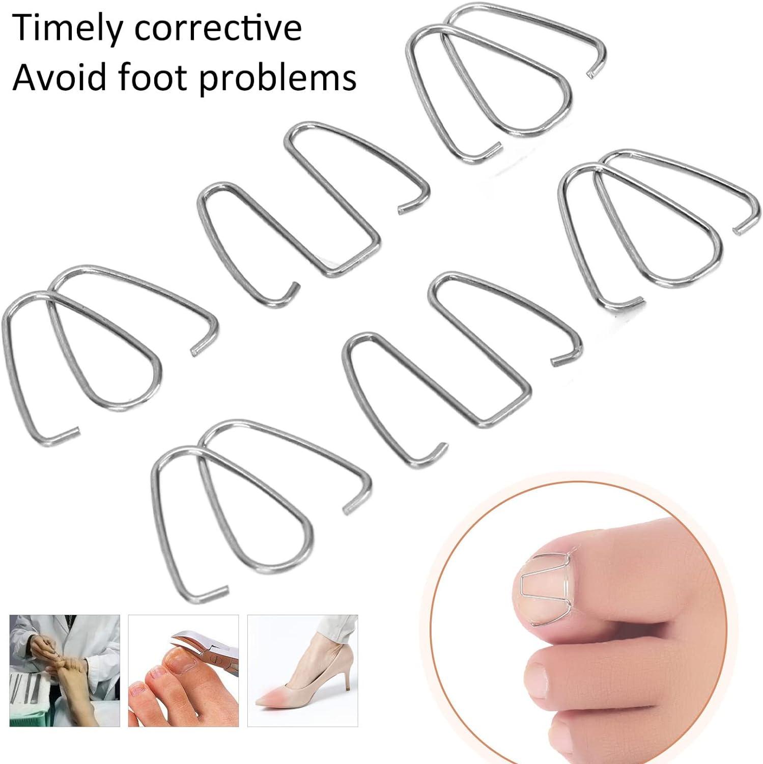 Ingrown Nail Corrector Relieve Pressure Ingrown Toenail Wire Fixer ...