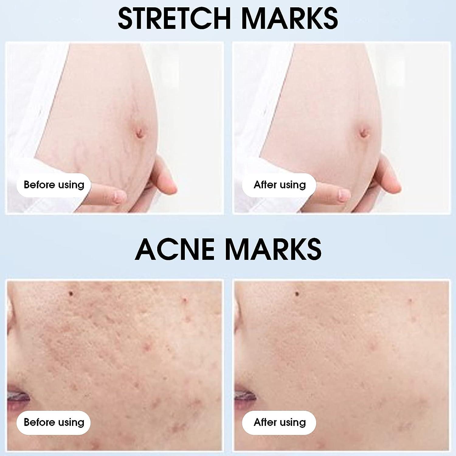 Scar Repair Cream 30G - Stretch Marks & Burn Marks Removal Ointment ...