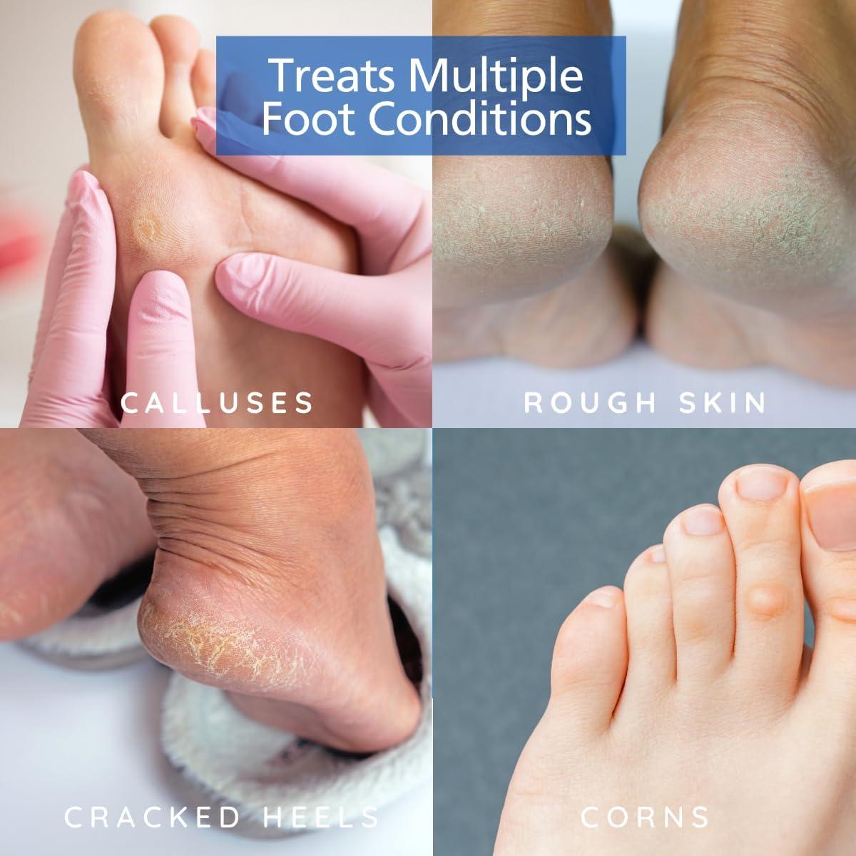 Callusan Urea Foot Cream Mousse 125ml - Instant Results for Dry Cracked ...