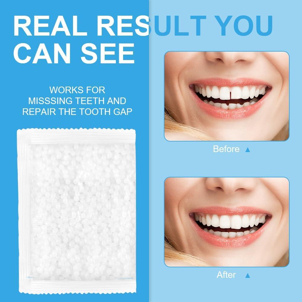 ACWOO Temporary Tooth Repair Kit 50g - Dental Filling Material for ...