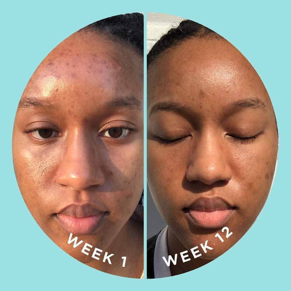 ZitSticka Blur Potion: Vitamin Supplement for Hyperpigmentation ...