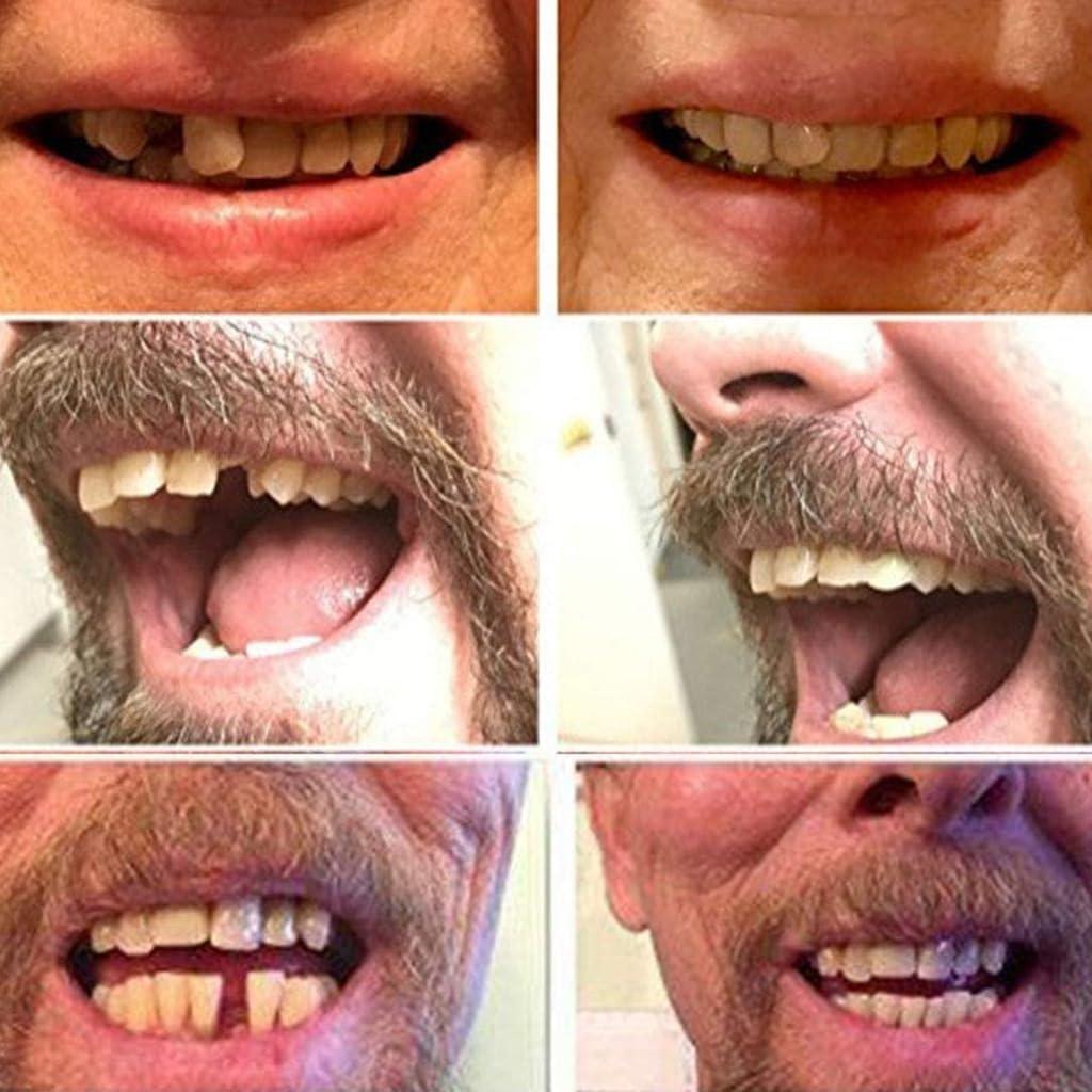 Set of 3 temporary replacement teeth to replace a missing tooth in ...