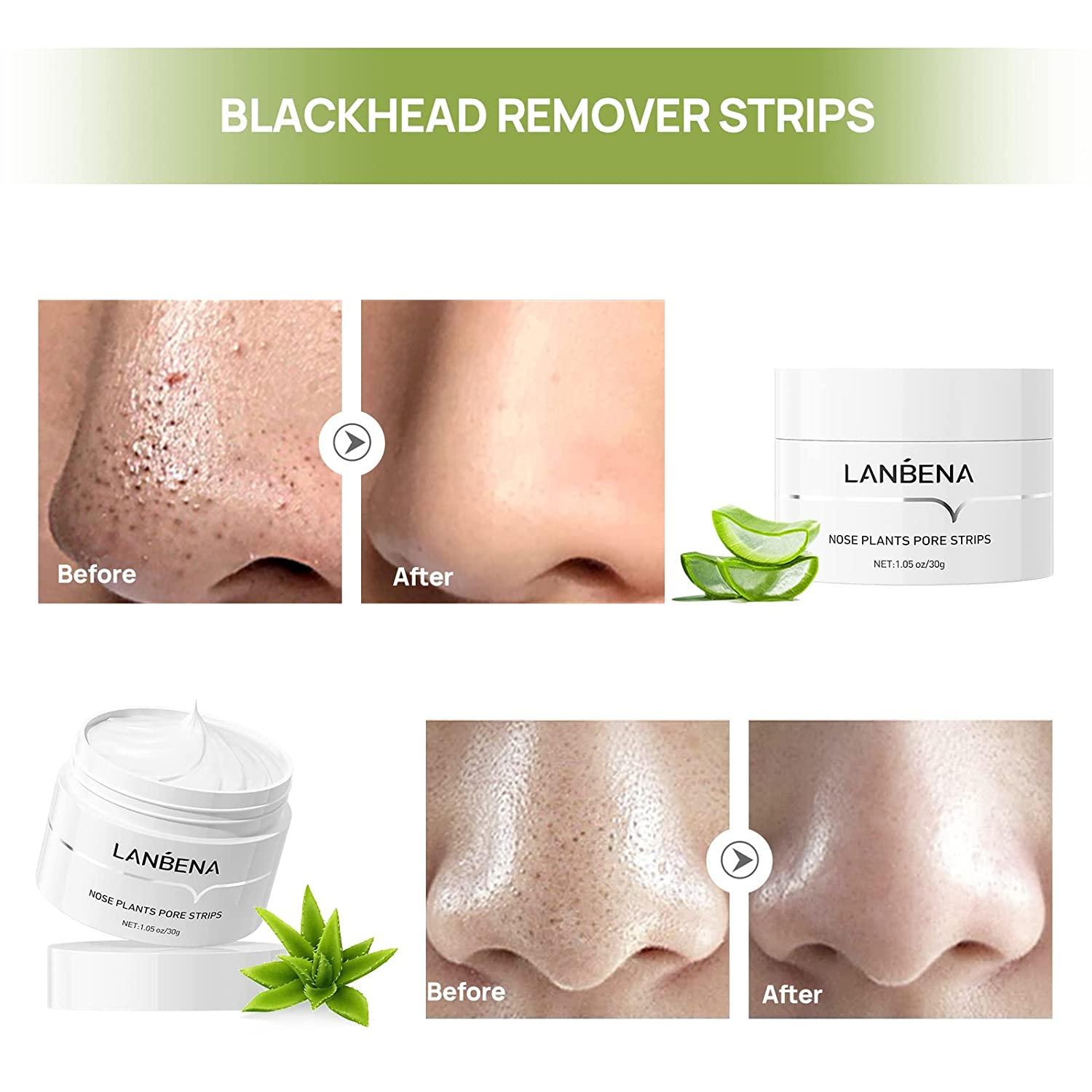 Lanbena Blackhead Remover Black Heads Remover From Face Black Head