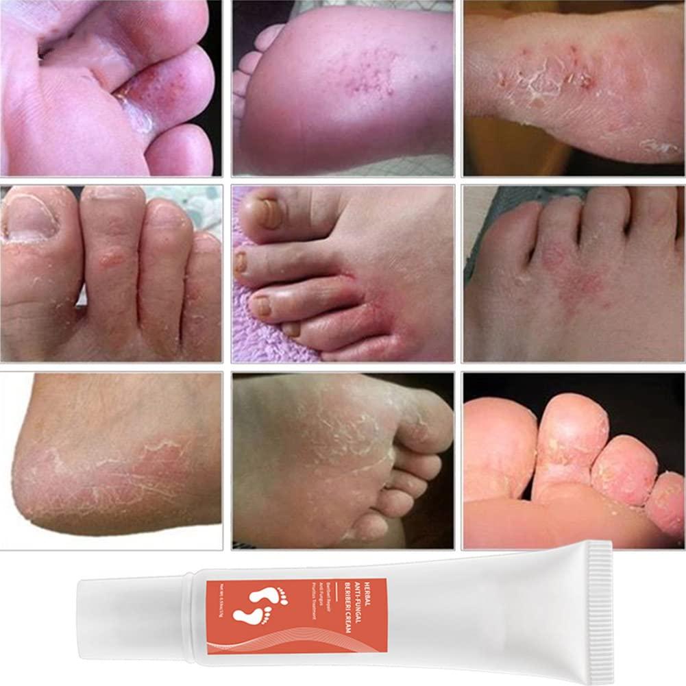 Allbestaye Anti-Fungal Foot Cream - Herbal Relief for Beriberi & Skin ...