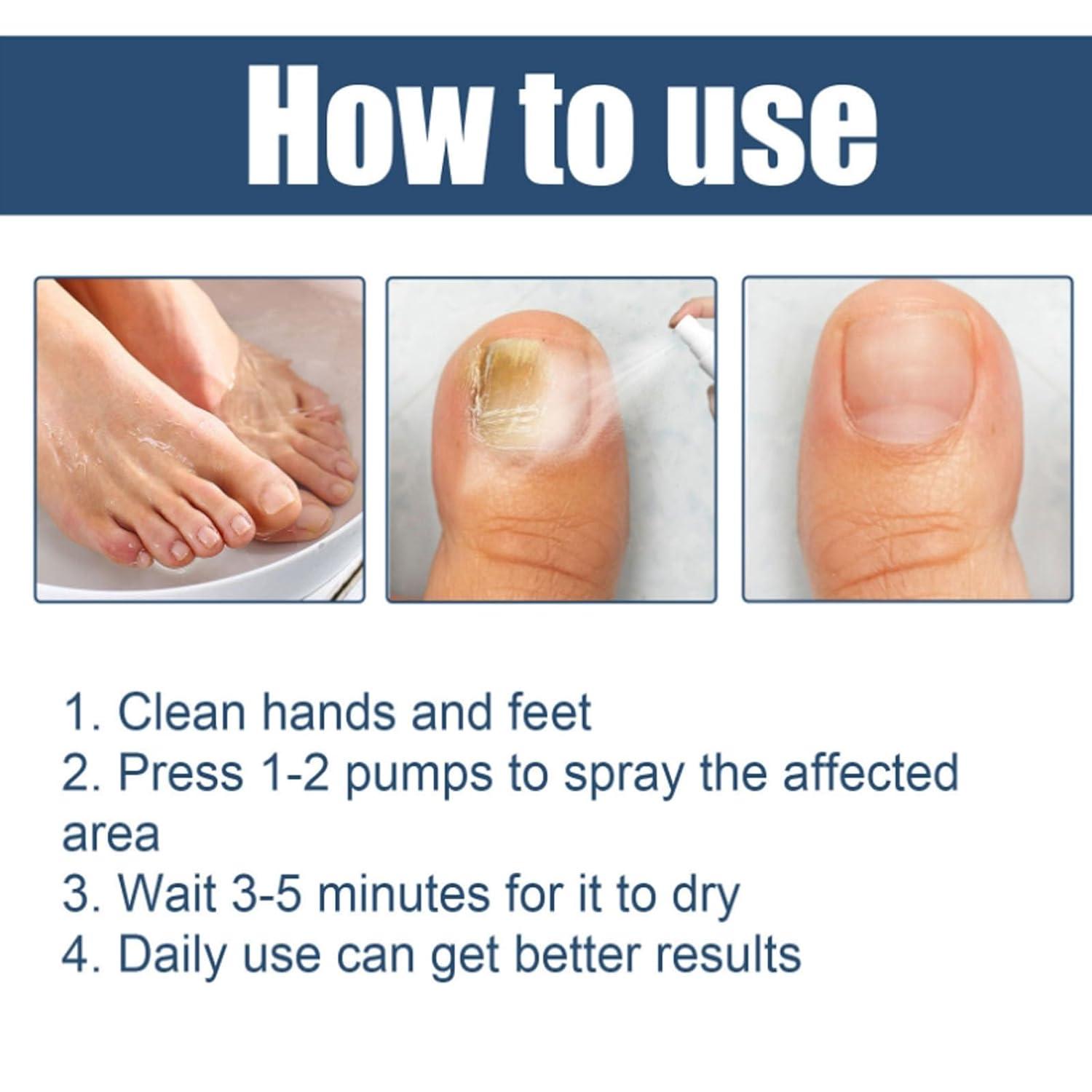 Furzero Nail Fungus & Athlete's Foot Treatment Spray - Medical Grade ...