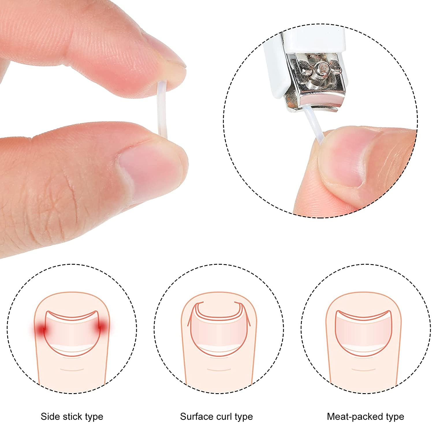 Ingrown Toenail Corrector Strips - 60 Pieces | Toe Nail Correction ...