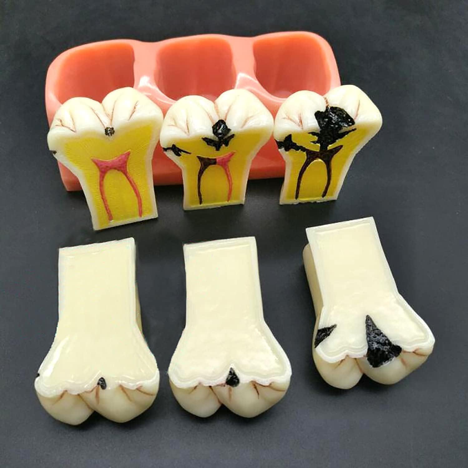 Buy Samnuerly 4-Fold Dental Teeth Caries Model - Removable Tooth ...