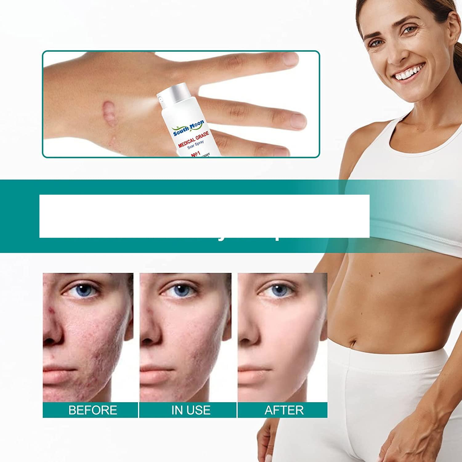 2pcs Advanced Scar Remove Spray & Cream Set (20g) - Physician ...