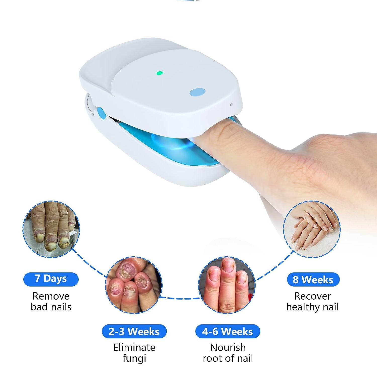 Effective Toenail Fungus Laser Remover Device for Onychomycosis ...