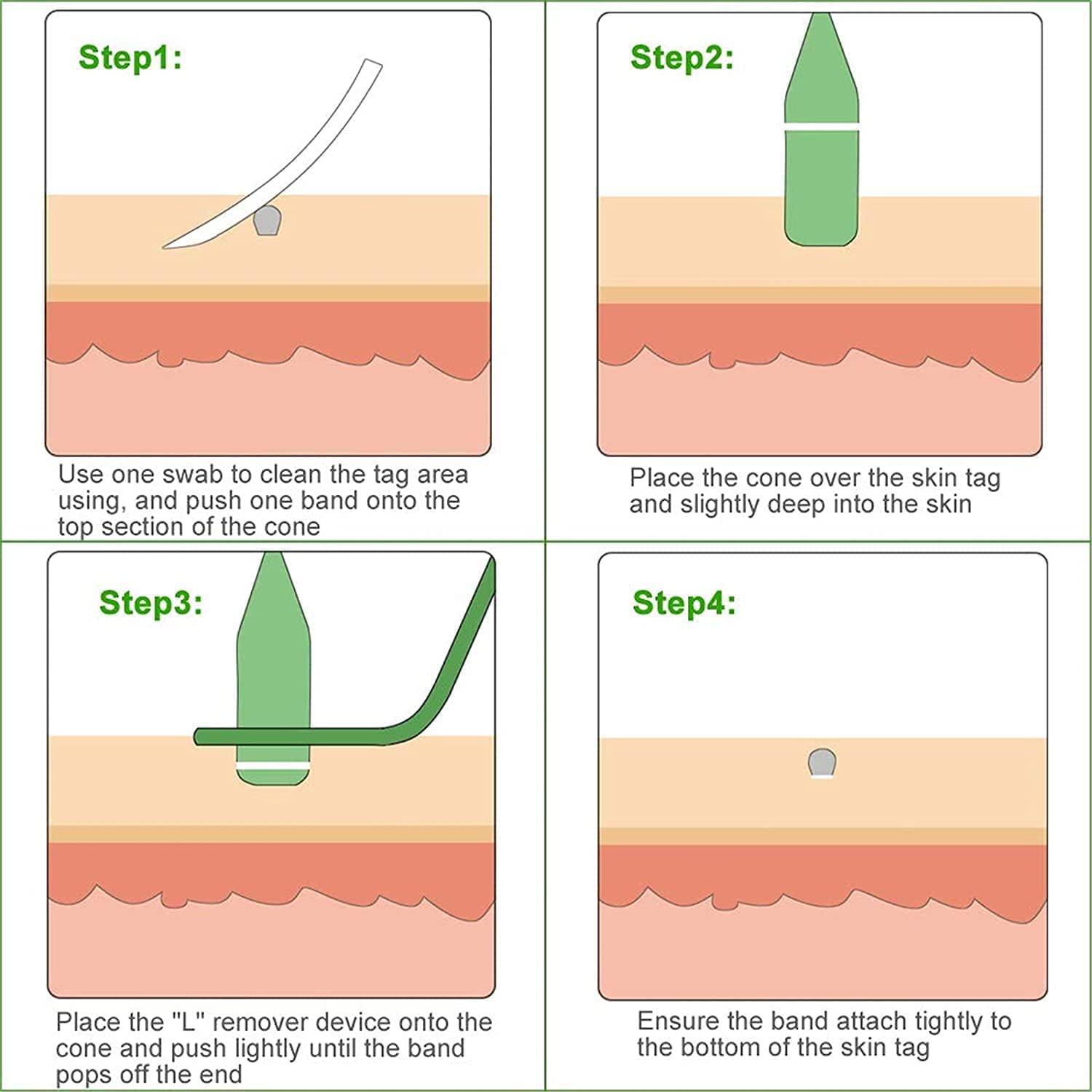 Micro Skin Tag Remover Kit with 20 Bands - Mole Removal for Small to ...