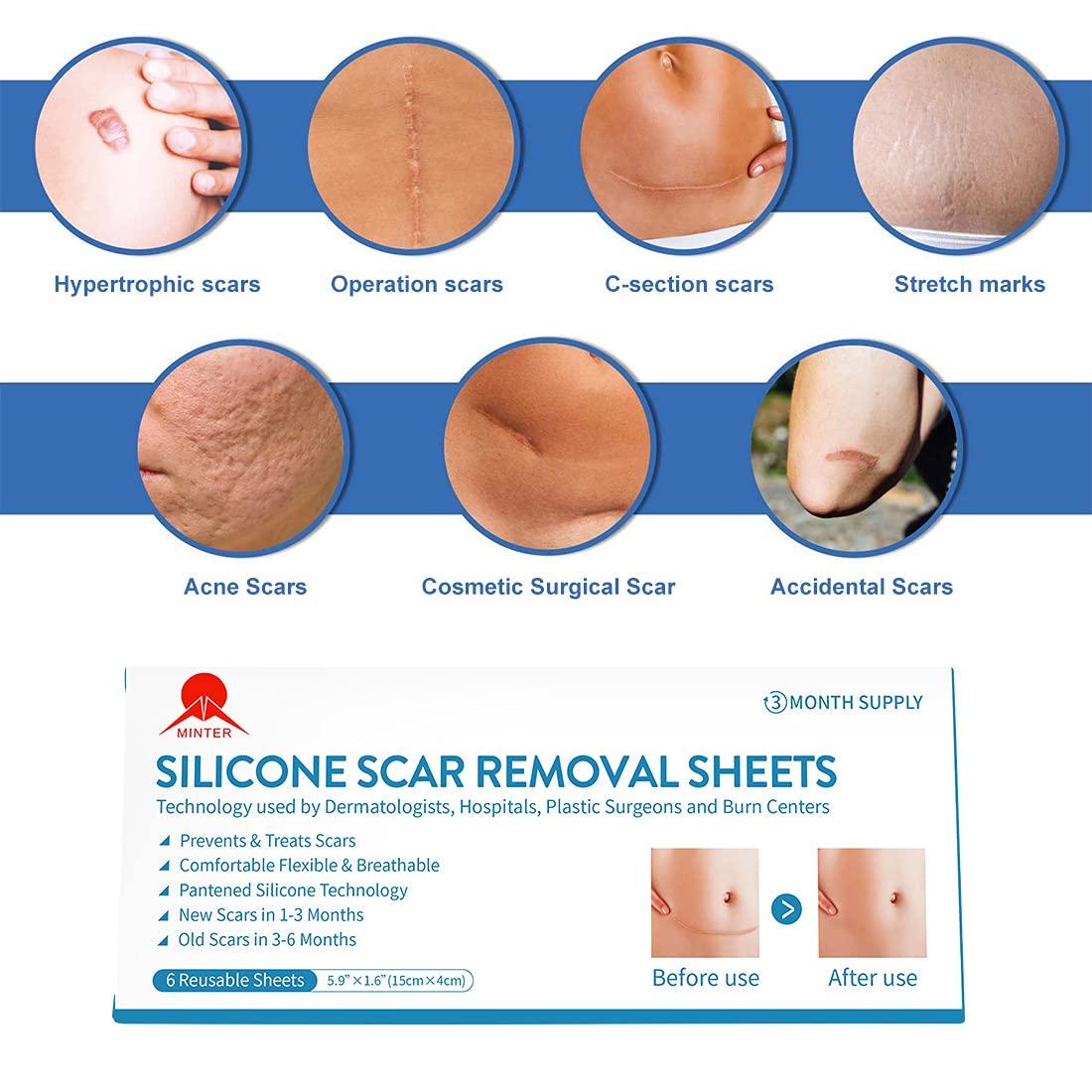 MT Healthy Silicone Scar Removal Sheets - 6 Pcs (5.9 x 1.6 inches) - 3 ...