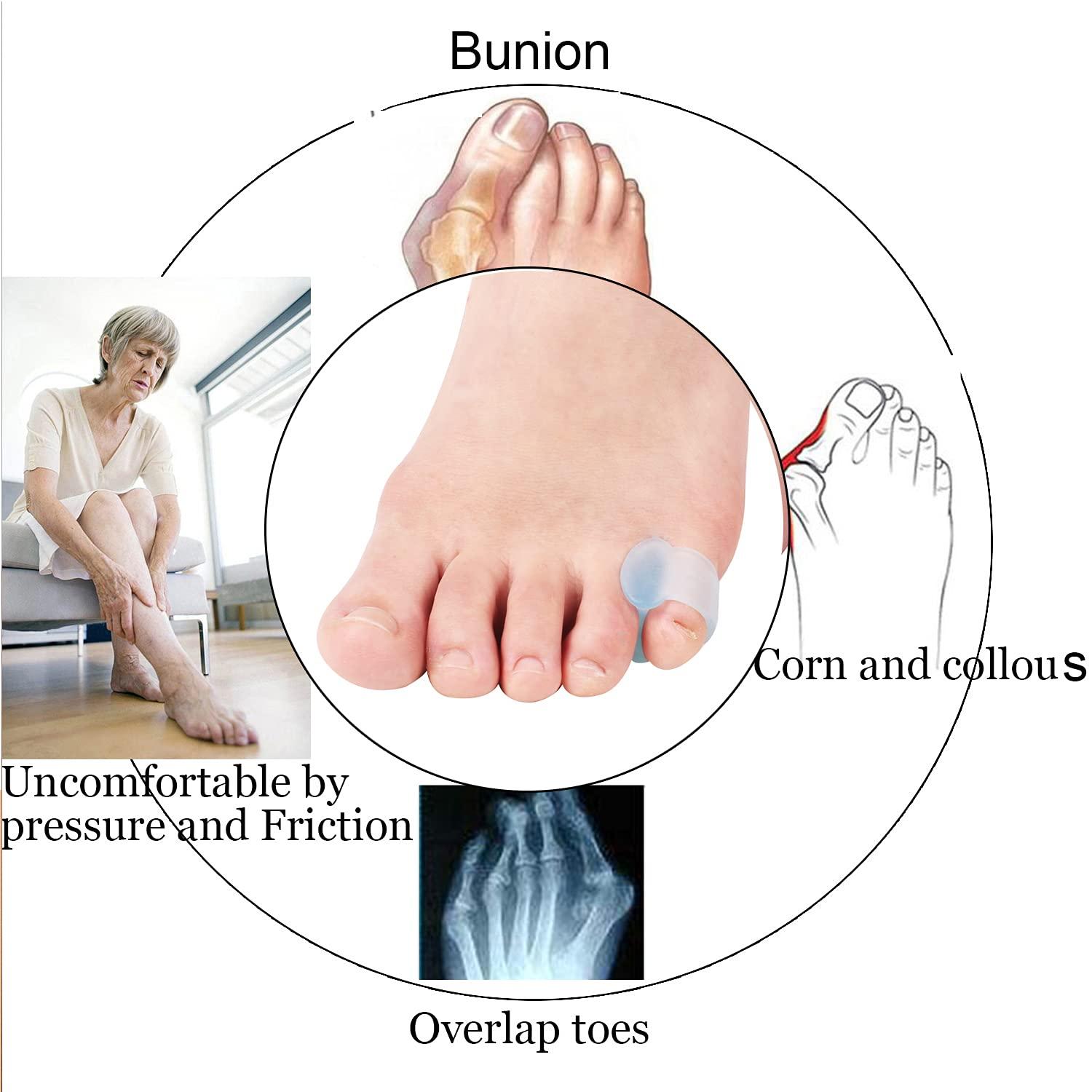 Yimanduo 10 Pcs Pinky Toe Splint & Gel Separators - Toe Straightener ...